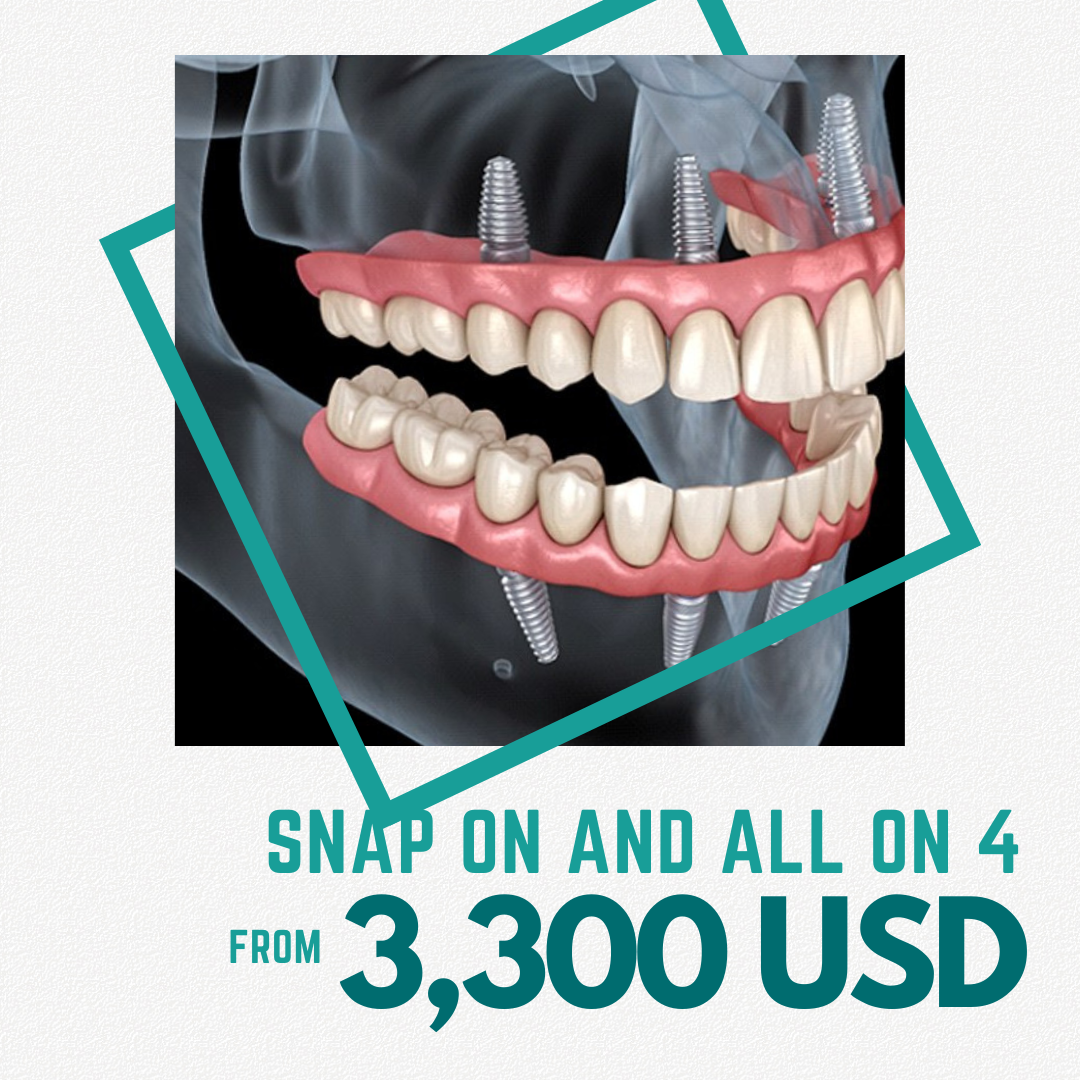 Dental Office Tijuana | All on 4 and Snap On Dentures